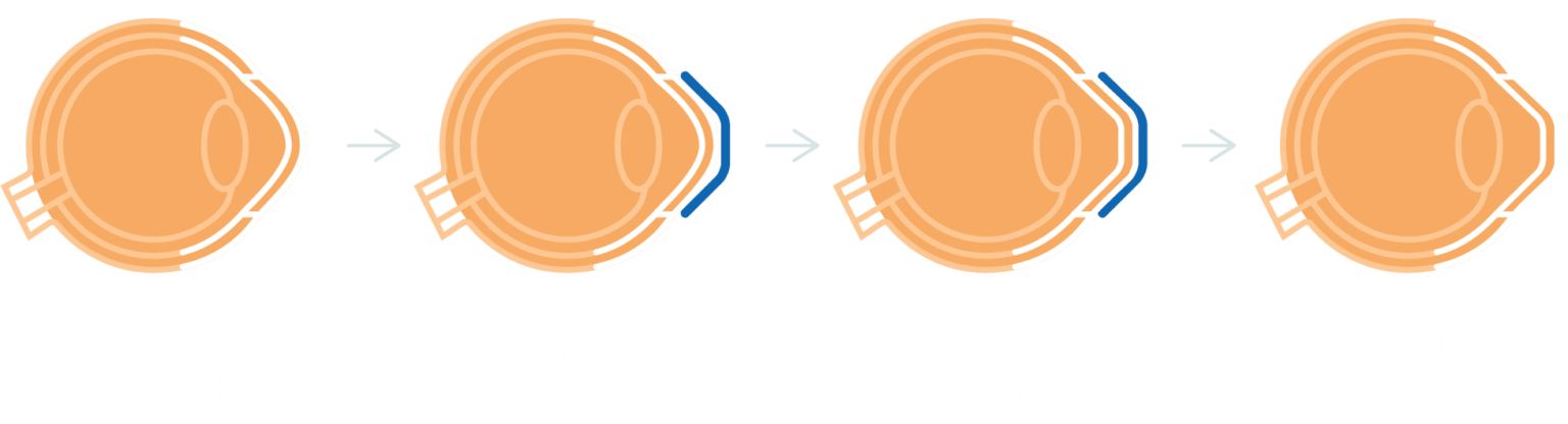 Ortho K Singapore | Orthokeratology Singapore | Ortho K Lenses
