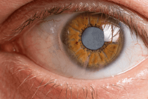 What Is High Myopia? Complications, Symptoms & more